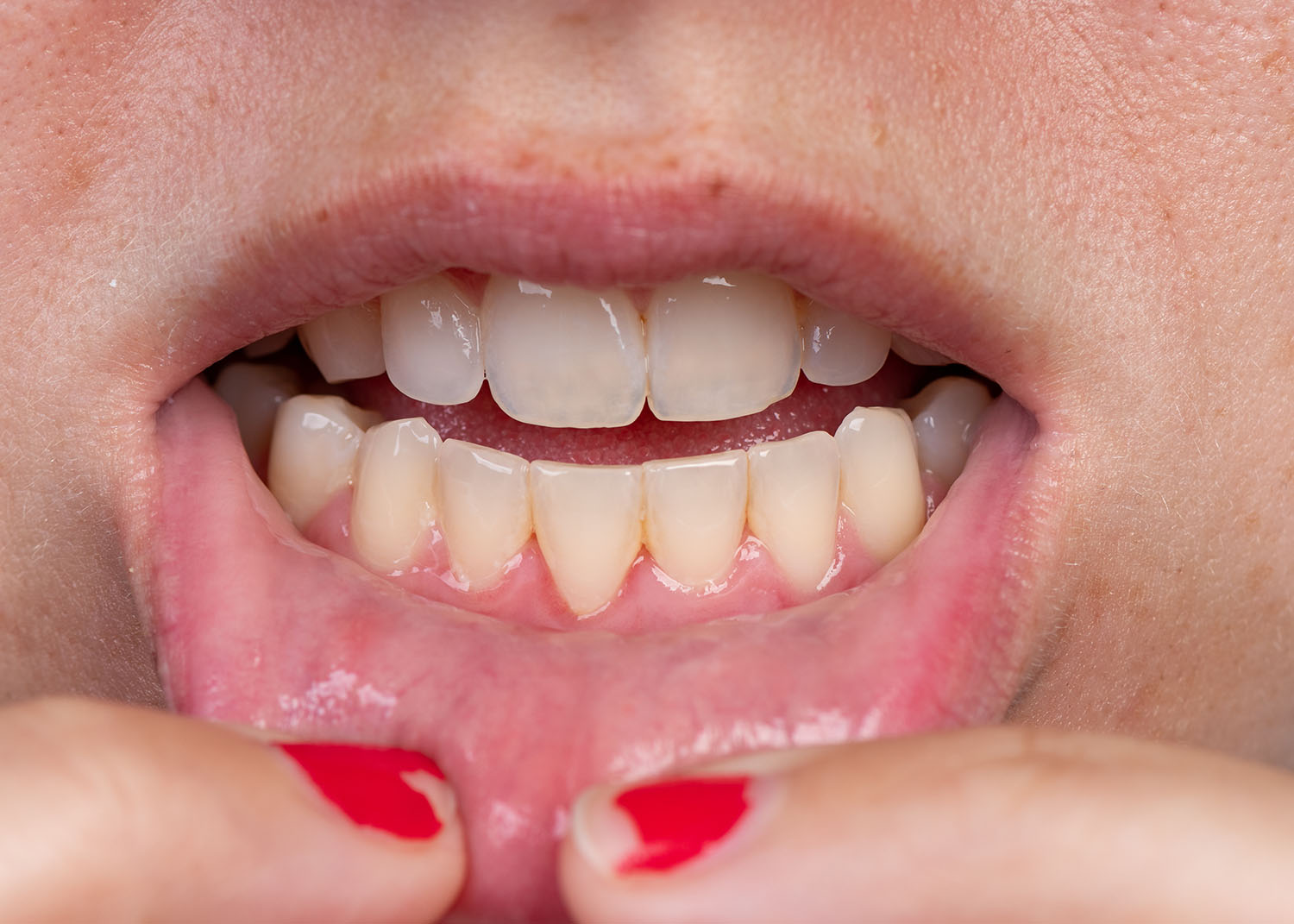Combat Receding Gums: Use Oil Pulling for receding gums